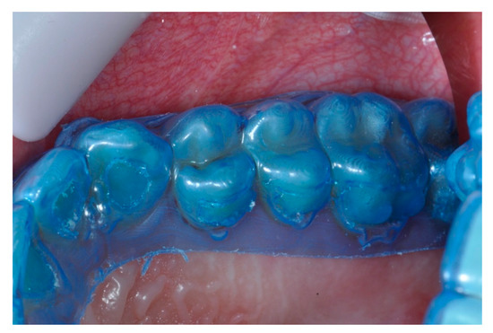 Effectiveness of a Selective Etching Technique in Reducing White Spots ...