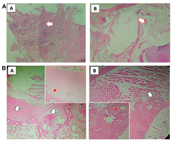 Application of Biodegradable PLGA-PEG-PLGA/CPC Composite Bone Cement in ...