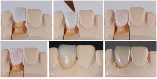 Dental Ceramics: Fabrication Methods and Aesthetic Characterization