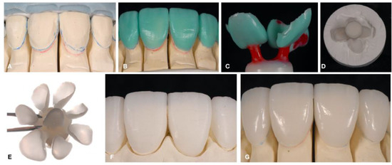 Dental Ceramics: Fabrication Methods and Aesthetic Characterization