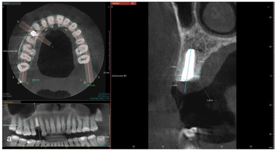 Advances in Materials and Concepts in Fixed Prosthodontics and Implant ...