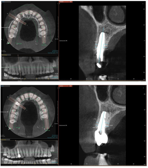 Advancement of Marginal Bone and Soft Tissue Aesthetics for Slope ...