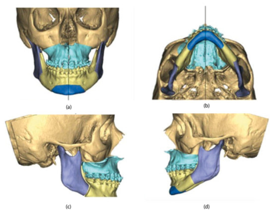 Clinical Accuracy of Splintless Maxillary Positioning with Aid of CAD ...