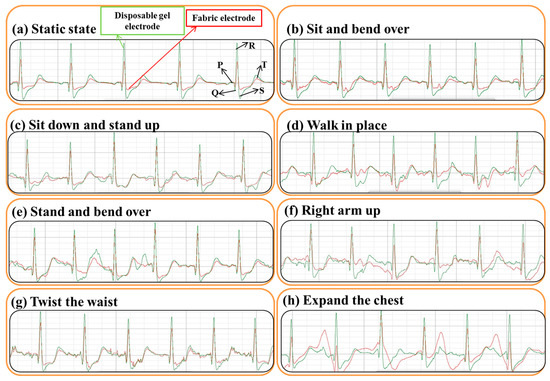 Fabric Electrode Monitoring of Dynamic and Static ECG Signal and ...