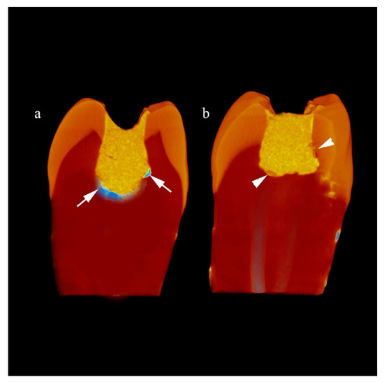 Evaluation of Microvoid and Microleakage Potential of Bulk-Fill Resin ...