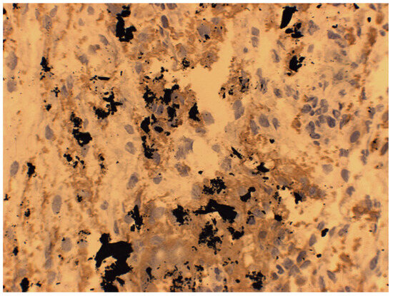 Toxicity, Irritation, and Allergy of Metal Implants: Historical ...