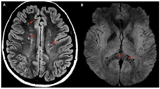 Ocular Fat Embolism Syndrome Following Surgical Repair of a Long Bone ...