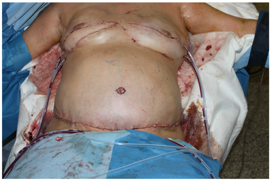 Severe Postoperative Complications Following Bilateral DIEP Flap Breast Reconstruction in a High ...
