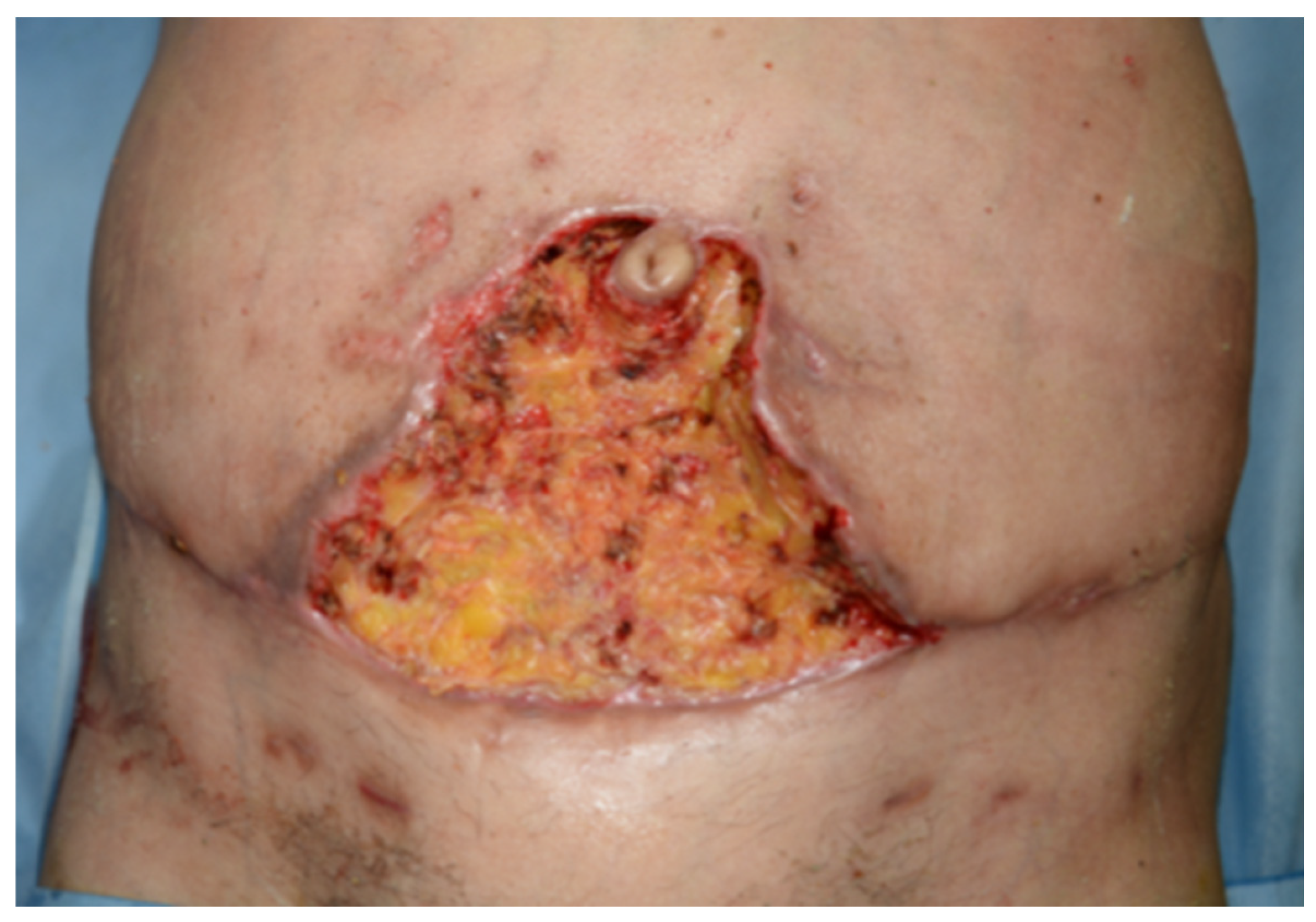 Severe Postoperative Complications Following Bilateral DIEP Flap Breast ...