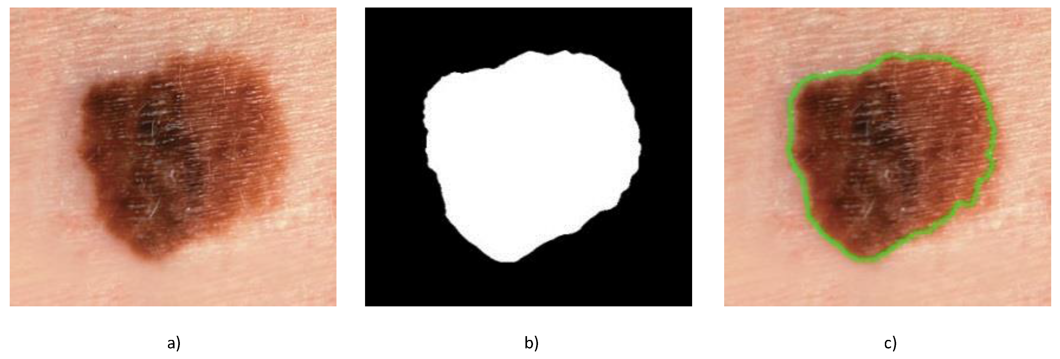 Computation Free Full Text An Svm Framework For Malignant Melanoma