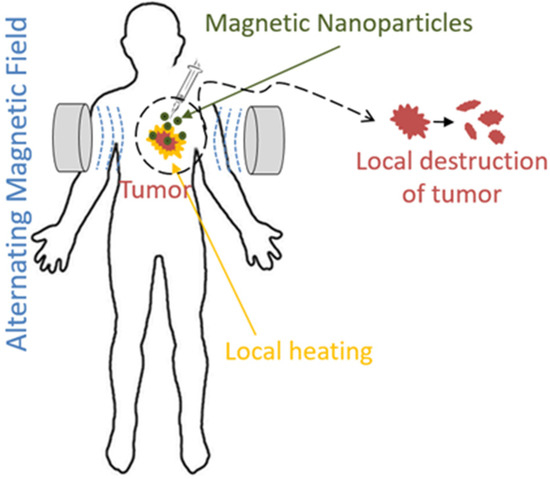 Natural Convection of Blood–Magnetic Iron Oxide Bio-nanofluid in the Context of Hyperthermia ...