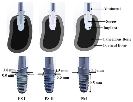 Computational Investigation of Dental Implant Restoration Using ...