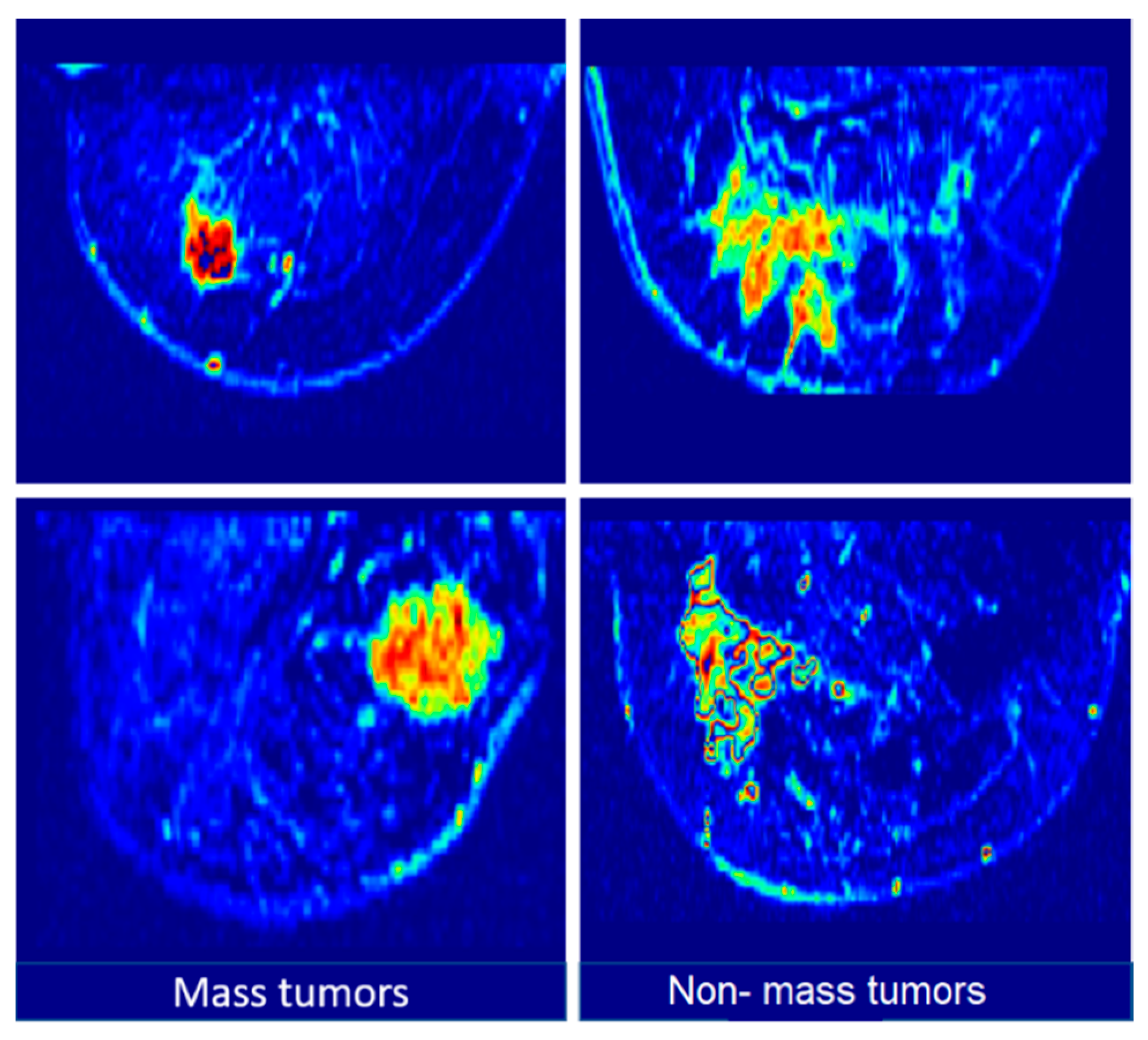 Pdf Mri Breast Tumor Segmentation Using Different | My XXX Hot Girl Pdf Mri Breast Tumor Segmentation Using Different | My XXX Hot Girl
