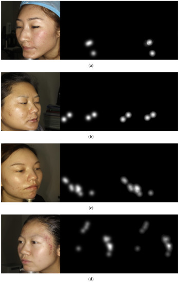 Attention Mechanism Guided Deep Regression Model for Acne Severity Grading