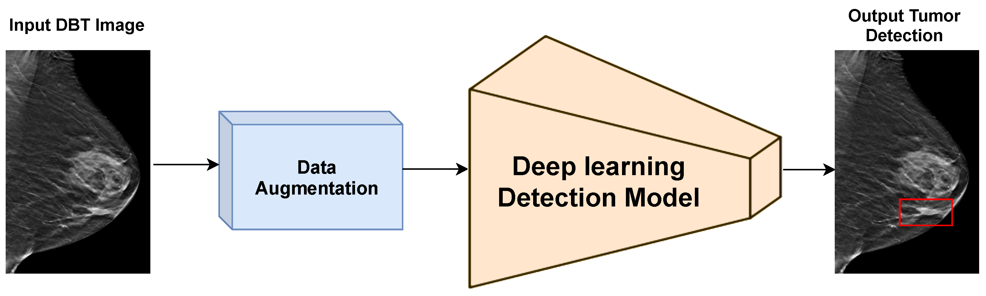 Detecting Breast Tumors in Tomosynthesis Images Utilizing Deep Learning ...