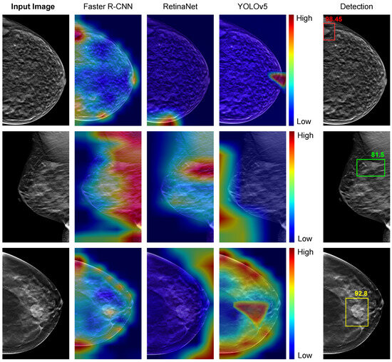 Detecting Breast Tumors in Tomosynthesis Images Utilizing Deep Learning ...
