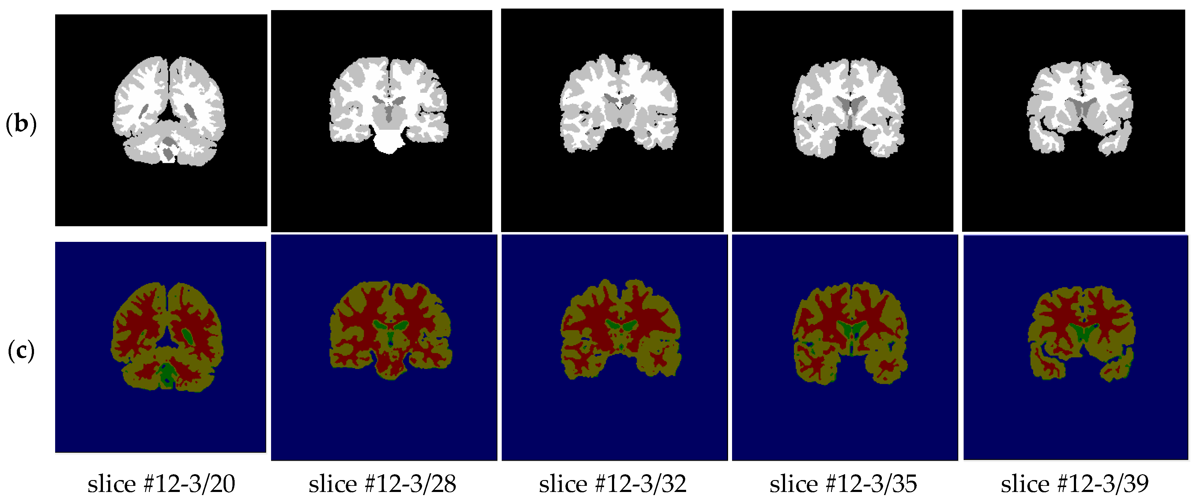 Computers | Free Full-Text | Enhancing Brain Segmentation in MRI ...