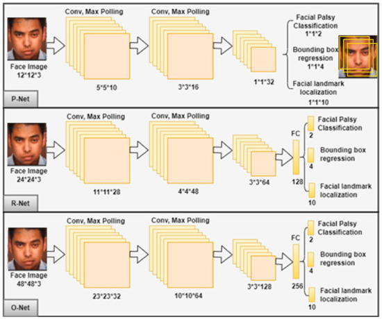 A Deep Learning Approach for Early Detection of Facial Palsy in Video ...