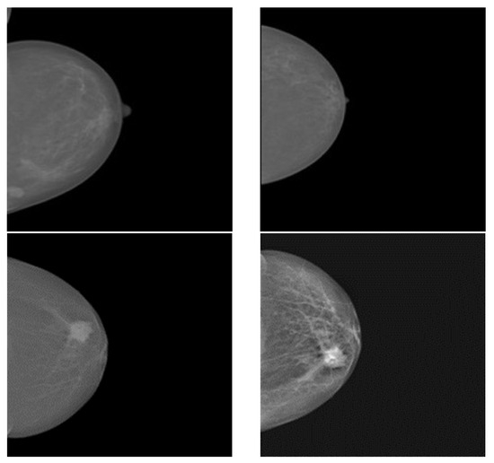 Deep Learning Based Breast Cancer Detection Using Decision Fusion
