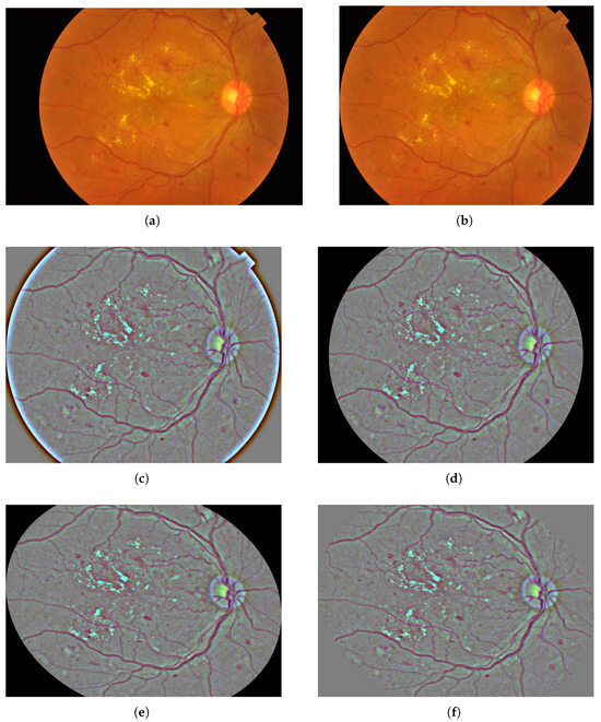 Interpretable Deep Learning for Diabetic Retinopathy: A Comparative ...