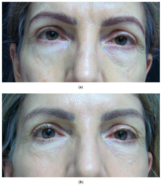 Periorbital Hyperpigmentation—Dark Circles under the Eyes; Treatment ...