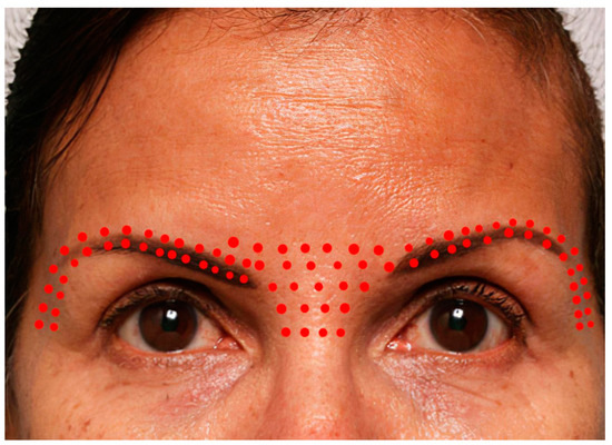 Expert Opinion on Non-Surgical Eyebrow Lifting and Shaping Procedures