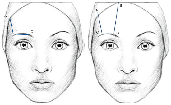 Expert Opinion on Non-Surgical Eyebrow Lifting and Shaping Procedures