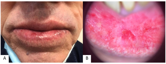 Exfoliative Cheilitis Lips