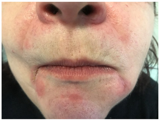 Minor Angular Cheilitis