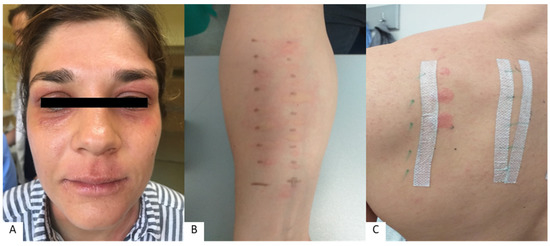 Factors Participating in the Occurrence of Inflammation of the Lips ...