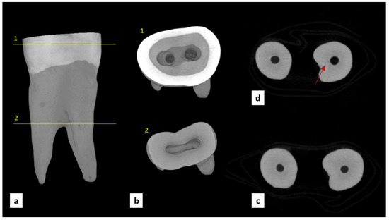 Post-Instrumentation Dentinal Microcracks Induced by Two NiTi Rotary ...