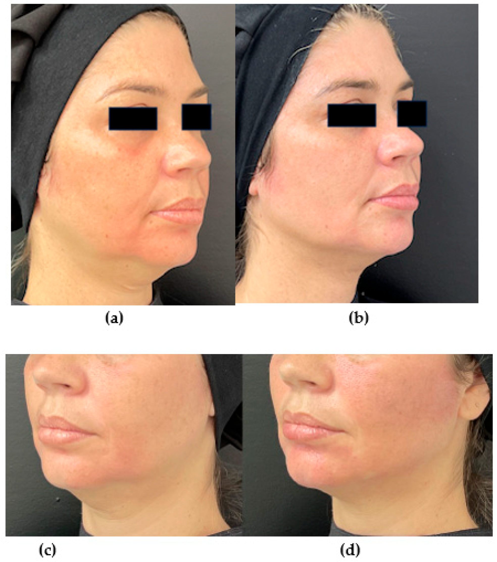 Global Facial Rejuvenation Using a New Cohesive, Highly Concentrated ...