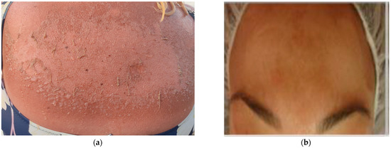 Carotenoids and Dermoaesthetic Benefits: Public Health Implications