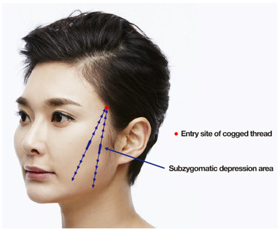 Cosmetics | Free Full-Text | What Are the Factors That Enable Thread ...