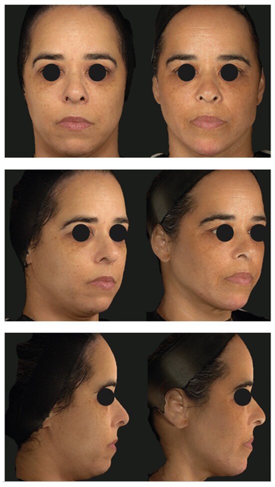 Blending Hyaluronic Acid and Calcium Hydroxylapatite for Injectable ...