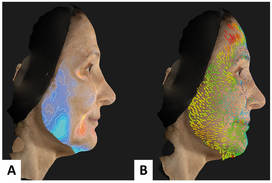 Blending Hyaluronic Acid and Calcium Hydroxylapatite for Injectable ...