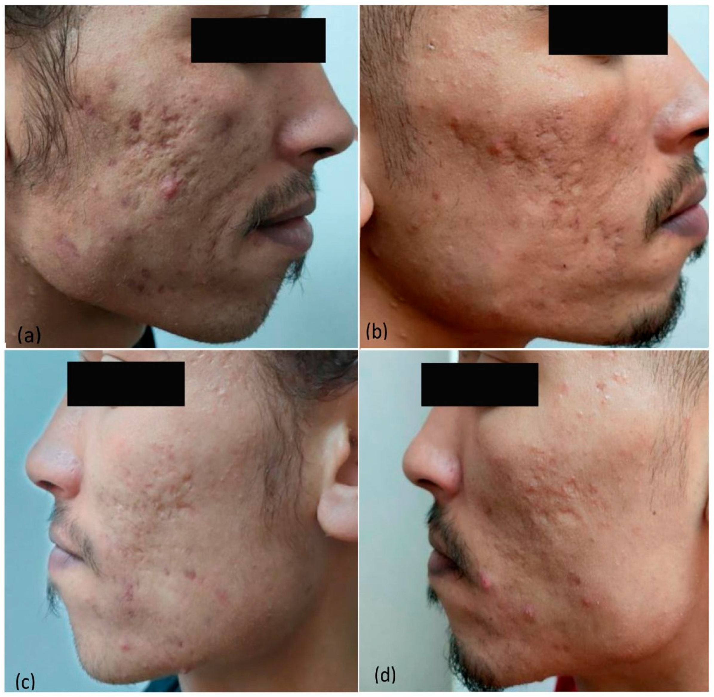Co2 laser acne scars store