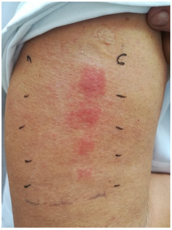 Unwanted Skin Reactions to Acrylates: An Update