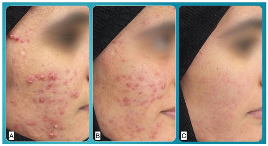 Pulsed Wave Mode of Fractional Radiofrequency Microneedling as a New ...