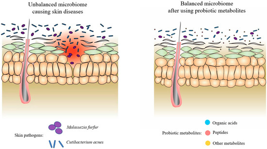 Inhibitory Effect of Probiotic Metabolites on Seborrheic Dermatitis and ...