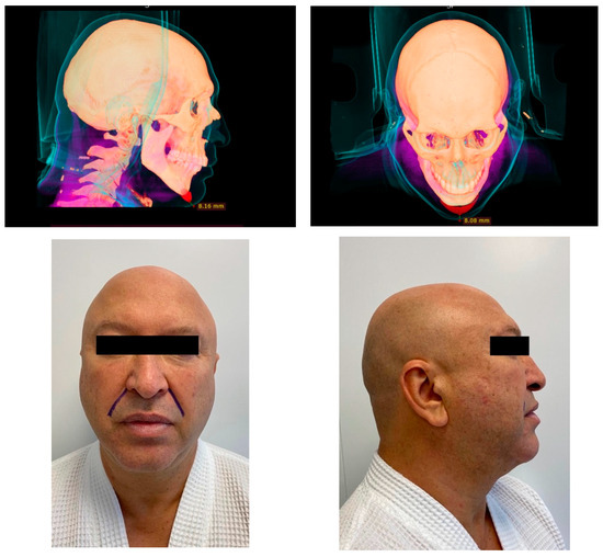 Methods for Chin Area Augmentation: Efficacy Evaluation and Prospects ...