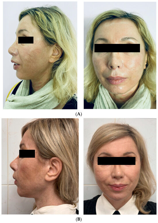 Methods for Chin Area Augmentation: Efficacy Evaluation and Prospects ...