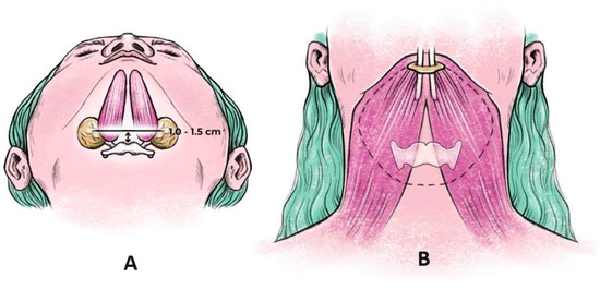 Advanced Surgical Approaches for the Rejuvenation of the Submental and ...