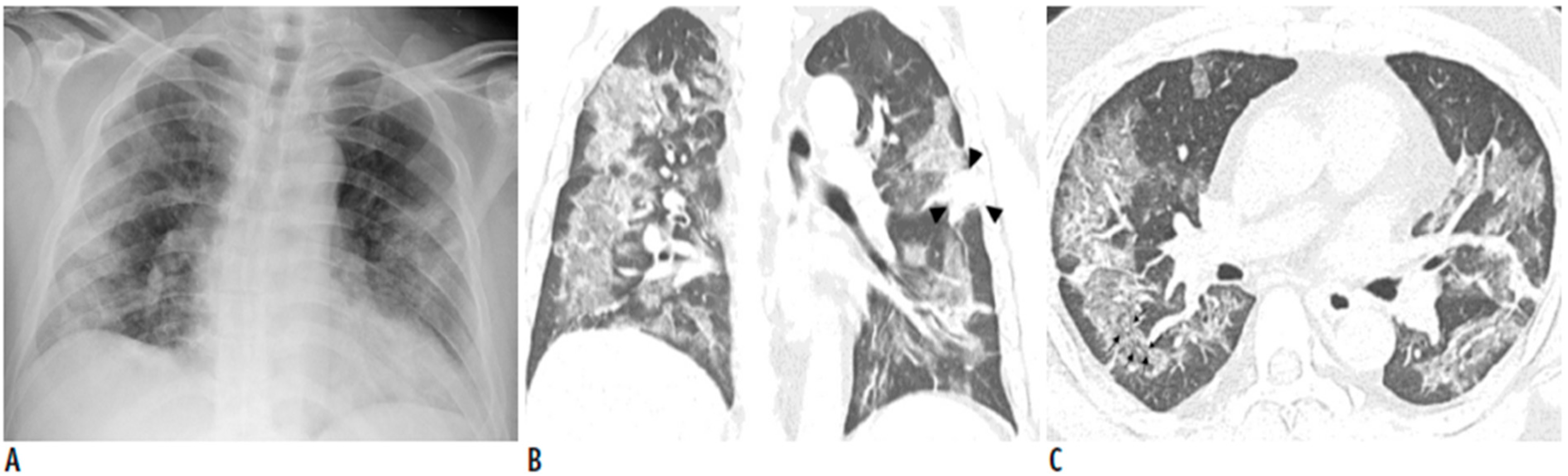Images of Chest Computer Tomography (CT) and Radiation (X-ray ...