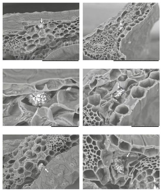 RETRACTED: Computerized Detection of Calcium Oxalate Crystal Progression