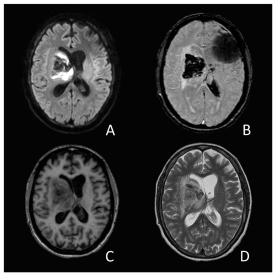 Intracerebral Hemorrhage, Visual Hallucination and COVID-19: What Is ...