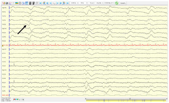 Frequently Suspected, Rarely Confirmed: The Complex Diagnostic Journey ...