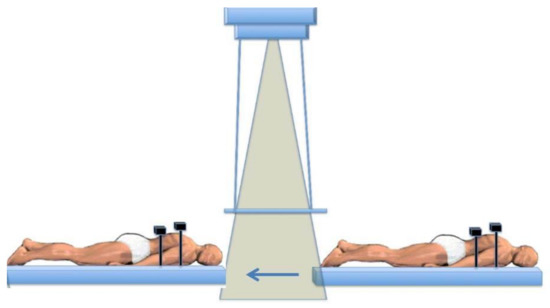 Total Body Irradiation for Hematopoietic Stem Cell Transplantation ...