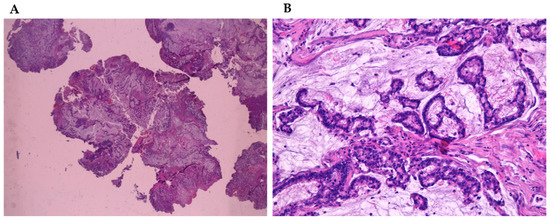 Malignant Sinonasal Tumors: Update on Histological and Clinical Management