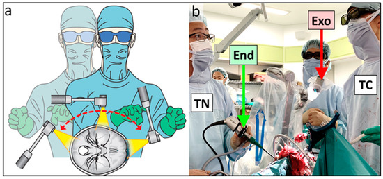 Current Oncology | Free Full-Text | Combined Exoscopic and Endoscopic ...